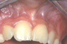 La freinectomie - Cabinet dentaire de Lagny-sur-Marne